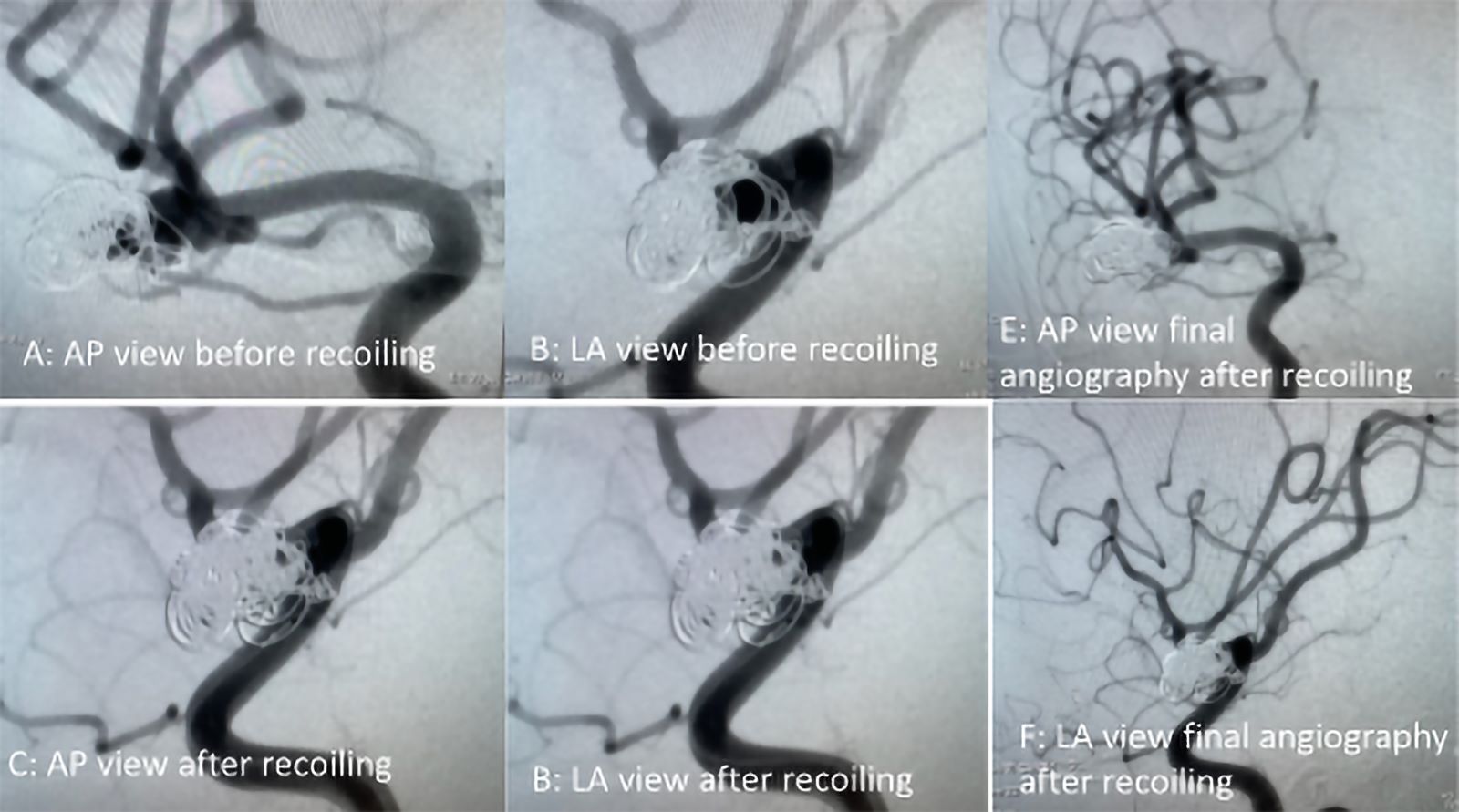 Outcome of patients with middle cerebral artery aneurysms who underwent ...